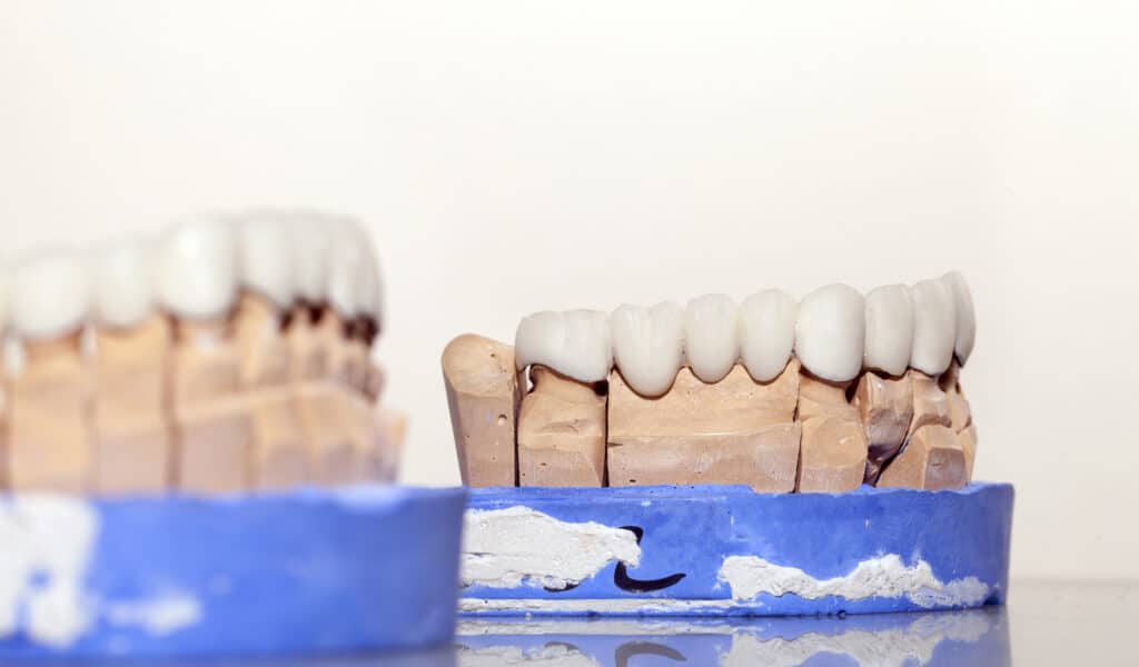 What is Fixed Dental Prosthesis and How Can It Improve Your Quality of ...